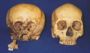 The Starchild Skull – Mexico Unexplained